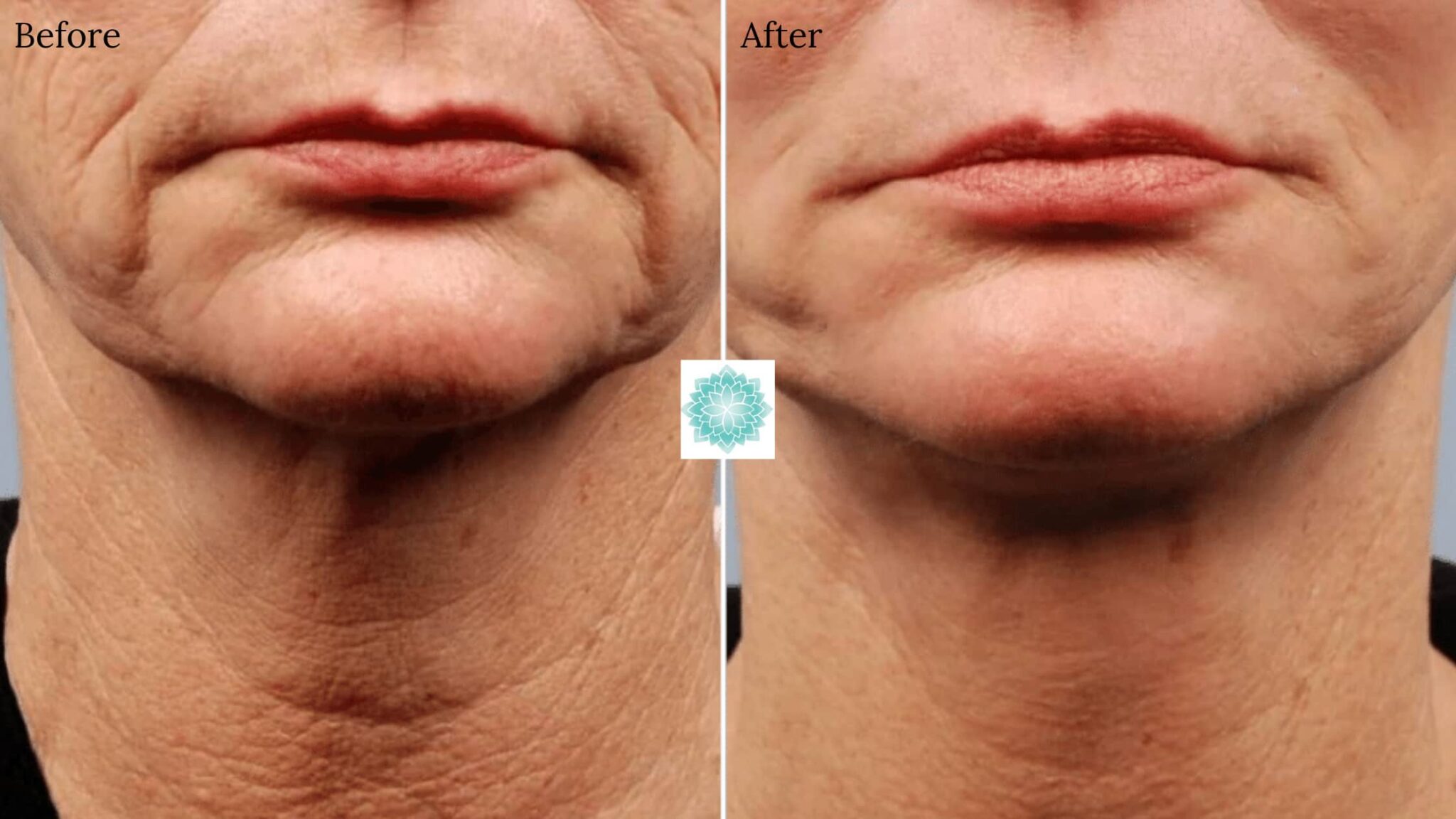 What to Expect with Morpheus8 Treatment